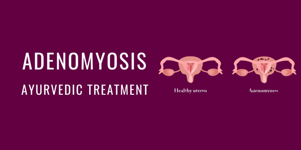 Adenomyosis Treatments - Ayurvedic Adenomyosis Treatment