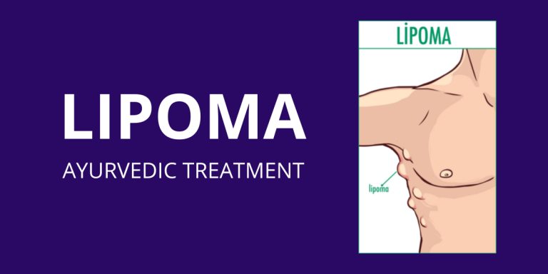 Ayurvedic Treatment For Lipoma