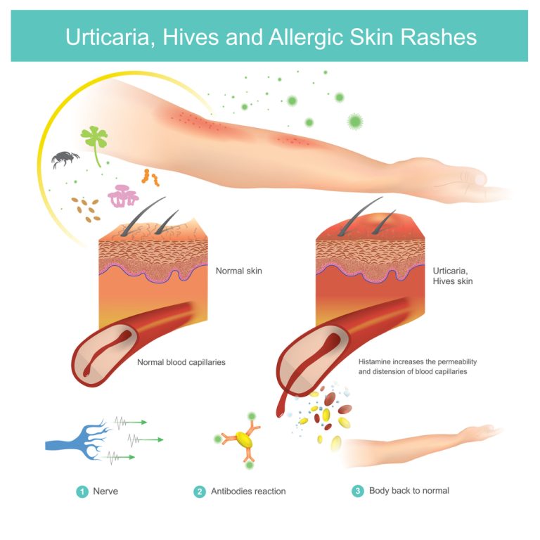 Ayurvedic Treatment For Urticaria Total Ayurveda ayurvedic-treatment-for-urticaria-total-ayurveda