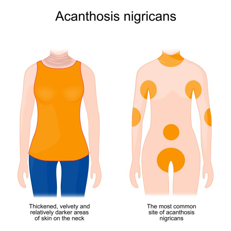 Acanthosis Nigricans Treatment