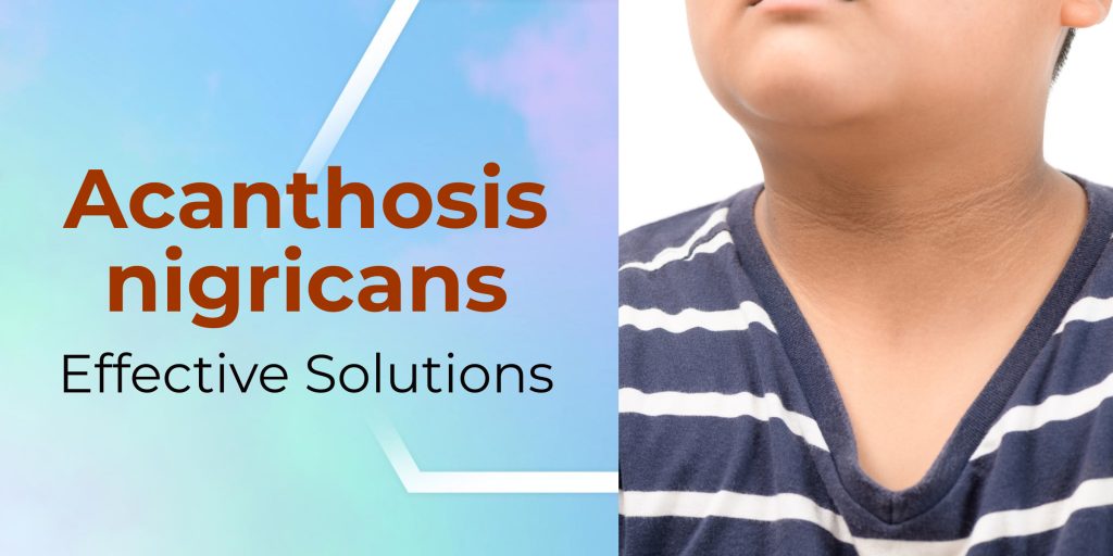 Acanthosis Nigricans Treatment