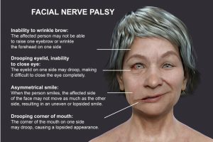 Facial Palsy