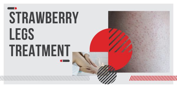 Strawberry Legs Treatment: What You Need To Know
